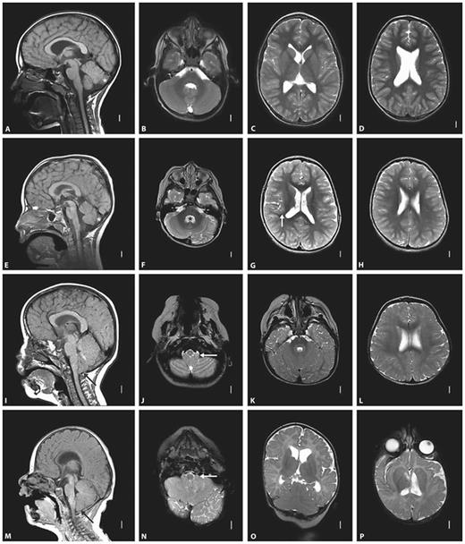 Investigation of TBR1 Hemizygosity: Four Individuals with 2q24 ...