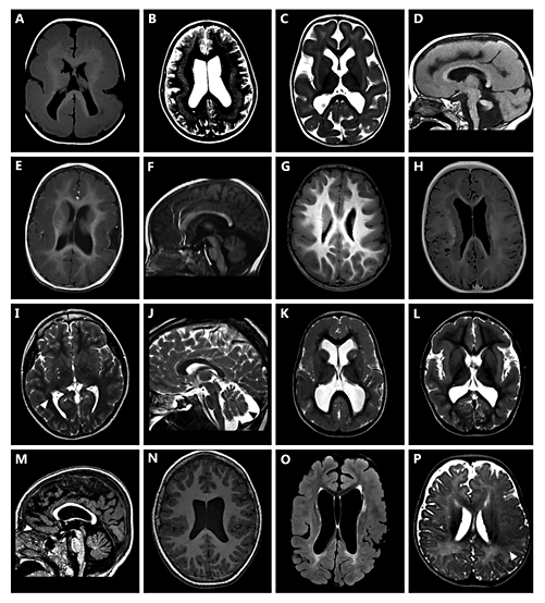 Genetic Basis of Brain Malformations | Molecular Syndromology | Karger ...