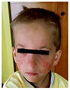 Bloom's Syndrome: Clinical Spectrum, Molecular Pathogenesis, and Cancer ...