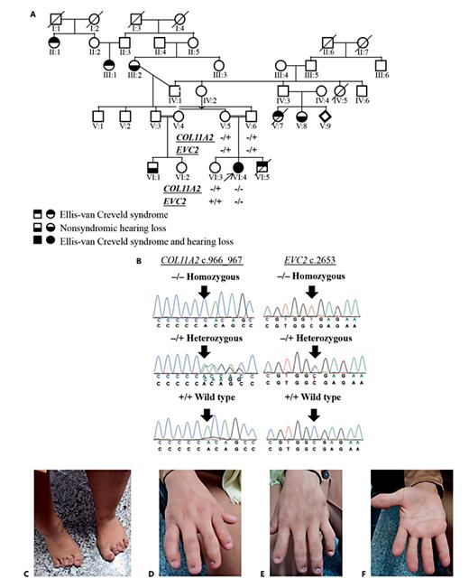 Dual Diagnosis of Ellis-van Creveld Syndrome and Hearing Loss in a ...