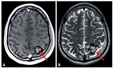 Cerebral Cavernous Malformations: An Update on Prevalence, Molecular ...
