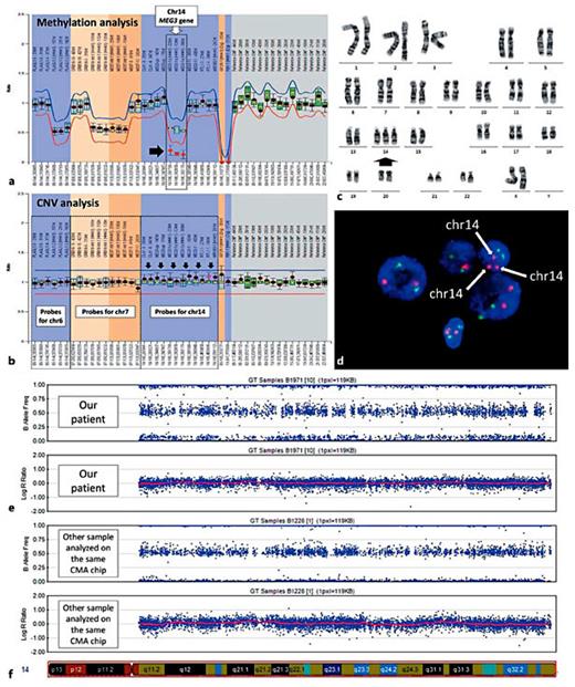 A New Case of a Rare Combination of Temple Syndrome and Mosaic Trisomy ...