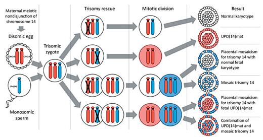 A New Case of a Rare Combination of Temple Syndrome and Mosaic Trisomy ...