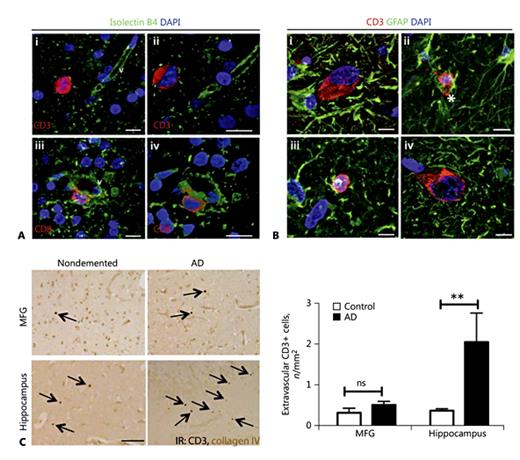 Extravascular CD3+ T Cells in Brains of Alzheimer Disease Patients ...