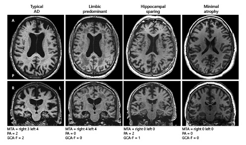 Brain Atrophy Subtypes and the ATN Classification Scheme in Alzheimer’s ...