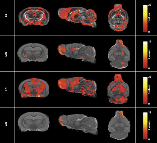 Diffusion Tensor Imaging Reveals Whole-Brain Microstructural Changes in ...