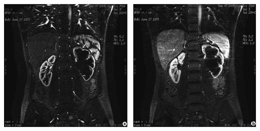 Magnetic Resonance Imaging in Acute and Chronic Kidney Diseases ...