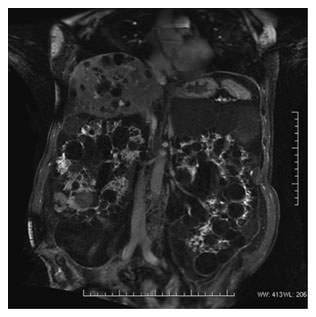 Magnetic Resonance Imaging in Acute and Chronic Kidney Diseases ...