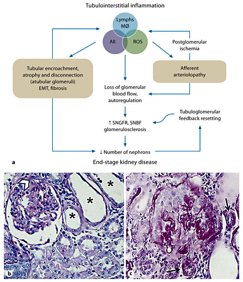The Role of Tubulointerstitial Inflammation in the Progression of ...