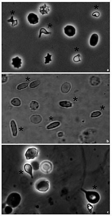 Urinary Red Blood Cells: Not Only Glomerular or Nonglomerular | Nephron ...