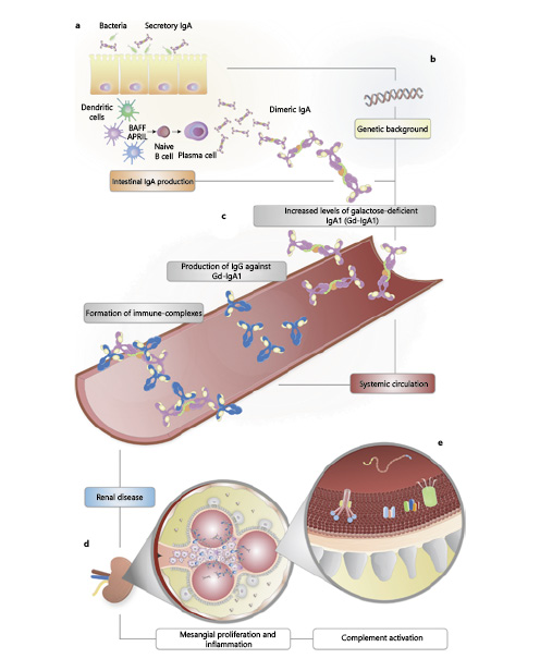 A Personalized Update on IgA Nephropathy: A New Vision and New Future ...