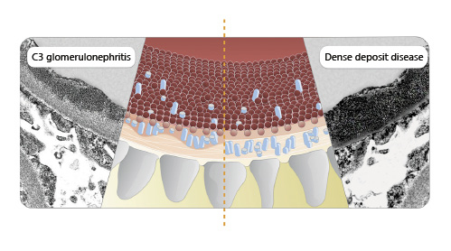 Update on C3 Glomerulopathy: A Complement-Mediated Disease | Nephron ...