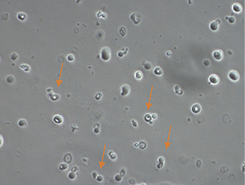 Thin Basement Membrane: An Underrated Cause of End-Stage Renal Disease ...