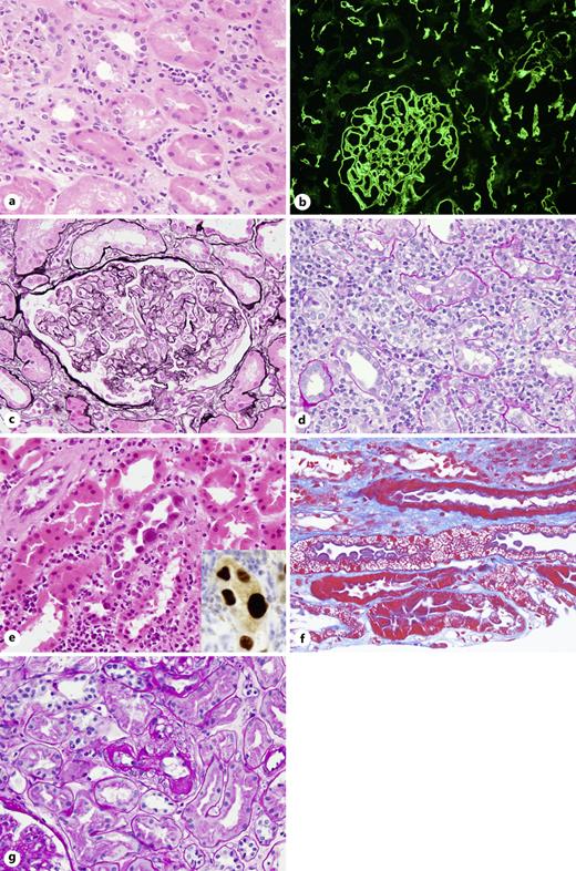The Chronology of Renal Allograft Dysfunction: The Pathological ...