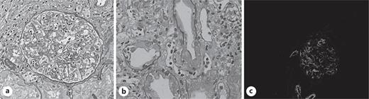 Mini Review Banff 2022 Updated Classification of Renal Allograft ...
