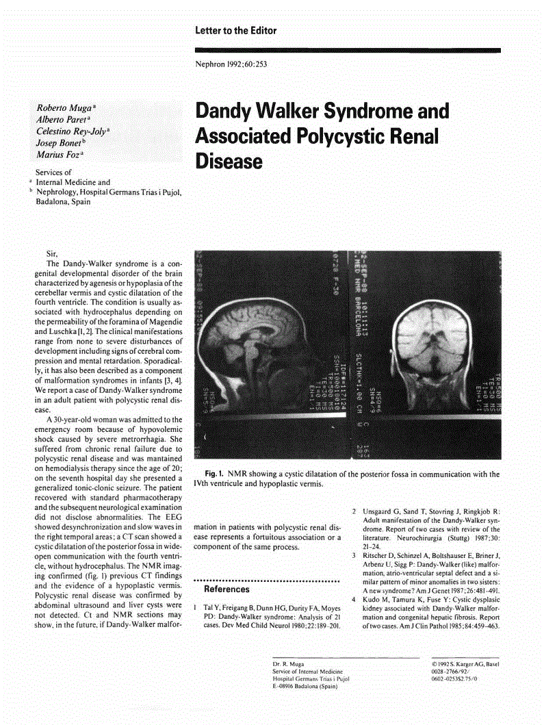 Dandy Walker Syndrome and Associated Polycystic Renal Disease | Nephron ...