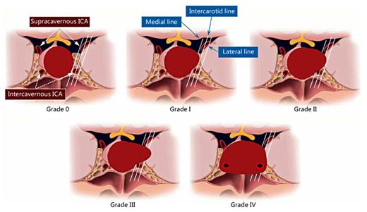 Aggressive Pituitary Tumors | Neuroendocrinology | Karger Publishers