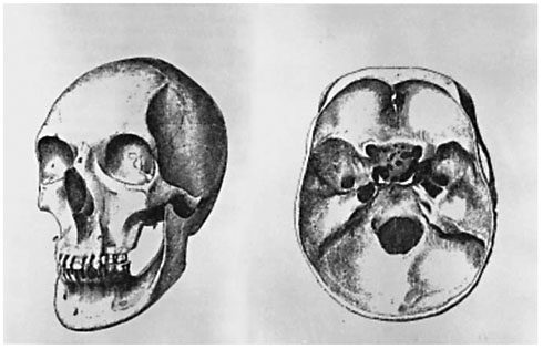 The History of Acromegaly | Neuroendocrinology | Karger Publishers