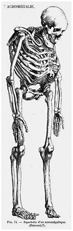 The History of Acromegaly | Neuroendocrinology | Karger Publishers