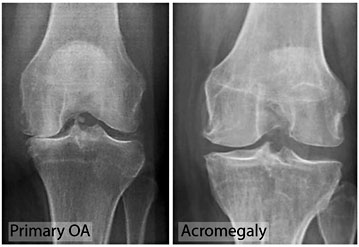 Bone and Joint Disorders in Acromegaly | Neuroendocrinology | Karger ...