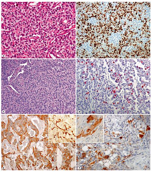 Four Neuroendocrine Tumor Types and Neuroendocrine Carcinoma of the ...