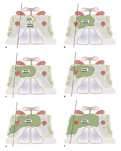 Diagnosis and Treatment of Parasellar Lesions | Neuroendocrinology ...