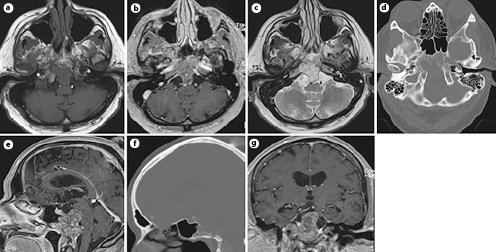 Skull Base Chordomas and Chondrosarcomas | Neuroendocrinology | Karger ...