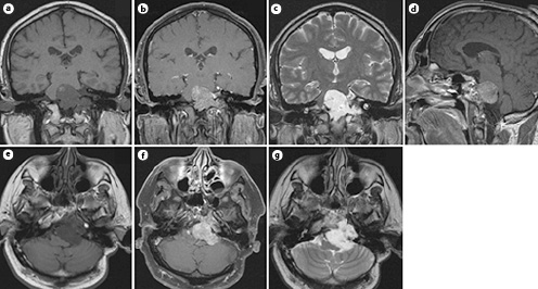 Skull Base Chordomas and Chondrosarcomas | Neuroendocrinology | Karger ...