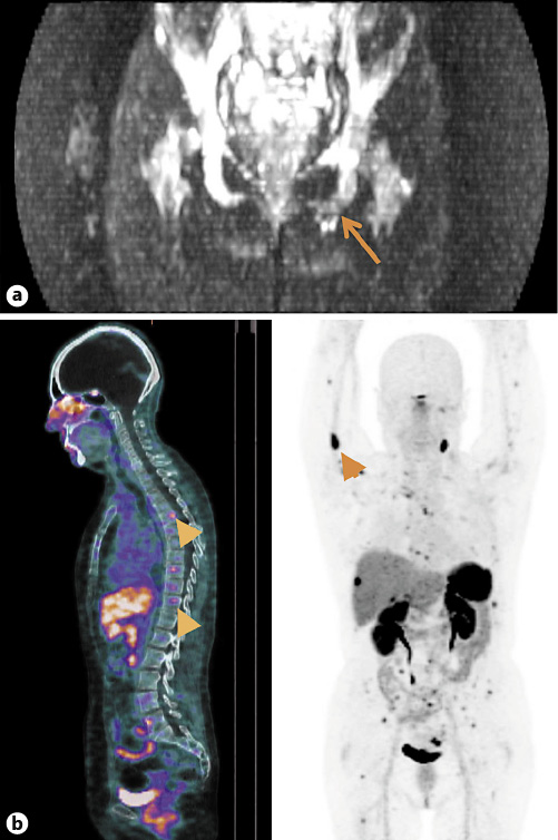 Bone Metastases in Neuroendocrine Tumors: Molecular Pathogenesis and ...