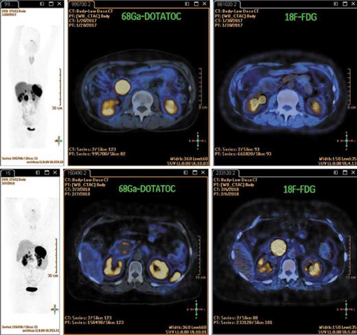 Dual-Tracer (68Ga-DOTATOC and 18F-FDG-)-PET/CT Scan and G1-G2 Nonfunctioning Pancreatic ...