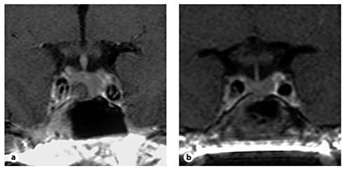 Pituitary Surgery for Cushing’s Disease | Neuroendocrinology | Karger ...