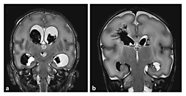 Early and Late Complications of Germinal Matrix-Intraventricular ...