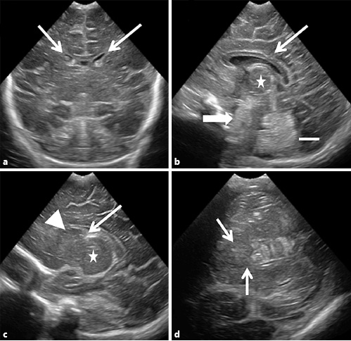 Head Ultrasound in Neonatal Hypoxic-Ischemic Injury and Its Mimickers ...