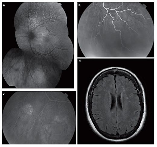 Multimodal Imaging of Spontaneously Shifting Primary Vitreoretinal ...