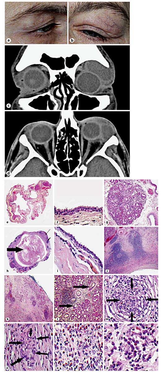 Lacrimal Gland Intra-Lobular Duct Cysts Associated with Focal ...