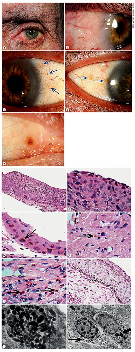 Unilateral Conjunctival in situ Squamous Carcinoma with Bilateral ...
