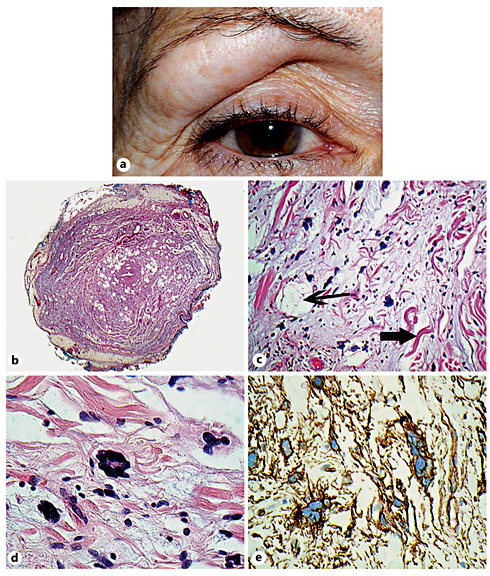 Unilateral Pleomorphic Lipoma of the Eyebrow | Ocular Oncology and ...