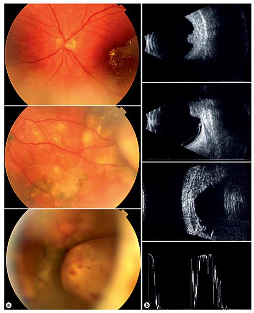 Reactive Retinal Astrocytic Tumor (Focal Nodular Gliosis): A Case ...