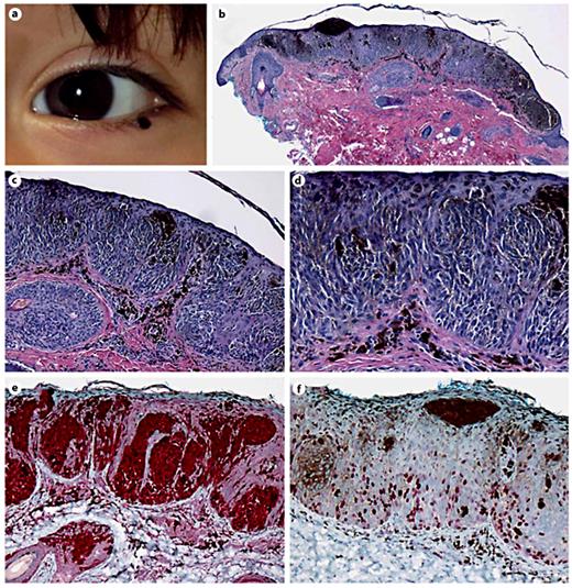 Pigmented Spindle Cell Nevus of Reed of the Eyelid | Ocular Oncology ...