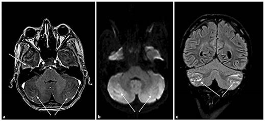 Bilateral Central Retinal Artery Occlusion Associated with Bilateral ...
