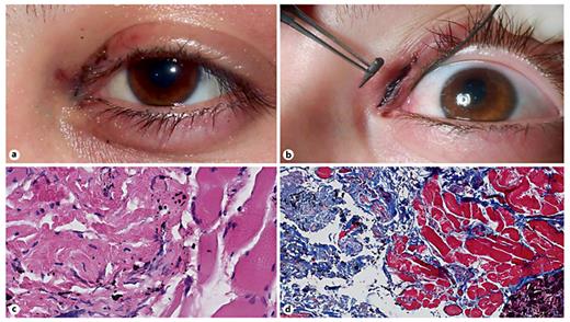Enlarging Pigmented Eyelid Mass Associated with Remote Pencil Trauma ...