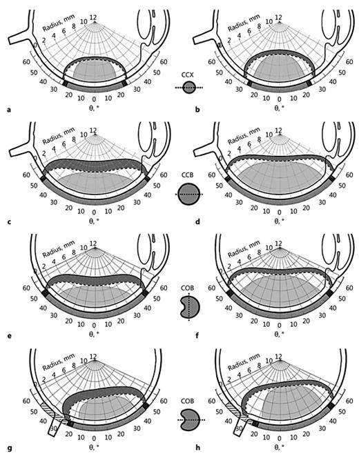 Dose Distributions and Treatment Margins in Ocular Brachytherapy with ...