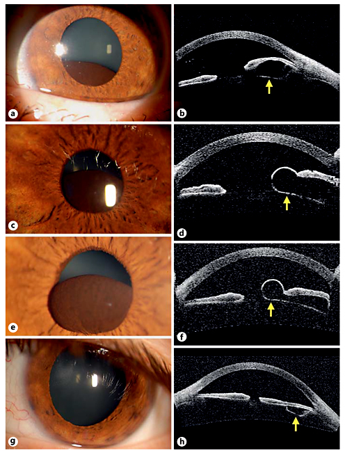 Advanced Midzonal Iris Pigment Epithelial Cyst Managed by Aspiration ...