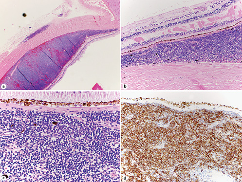 Choroidal Lymphoma Discovered on Ultrasound in a Patient with Suspected ...