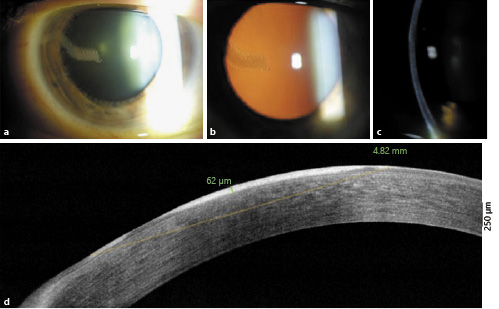Anterior Segment Optical Coherence Tomography of Ocular Cystinosis ...