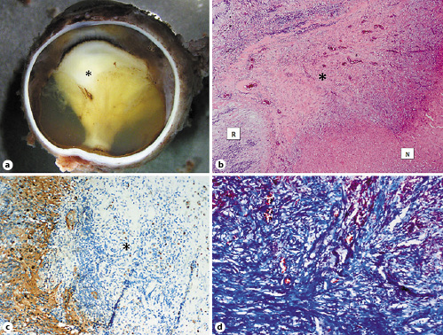 Pyogenic Granuloma of the Retina: A Case Series | Ocular Oncology and ...