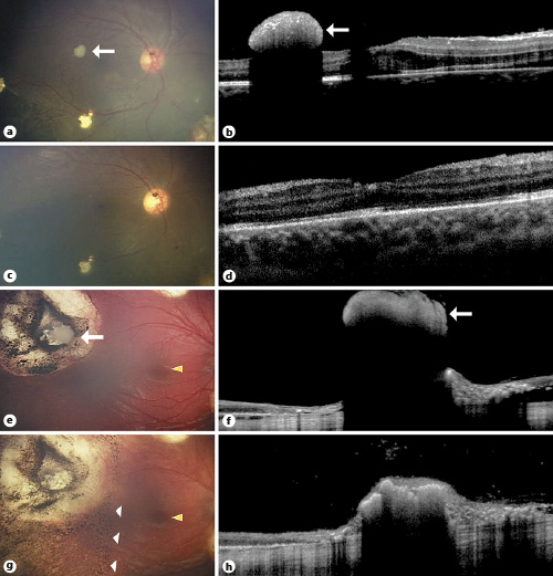 Precision Intravitreal Chemotherapy for Localized Vitreous Seeding of ...