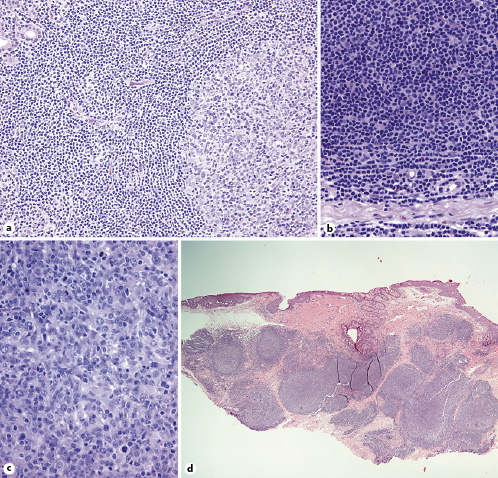 Understanding and Classification of Ocular Lymphomas | Ocular Oncology ...
