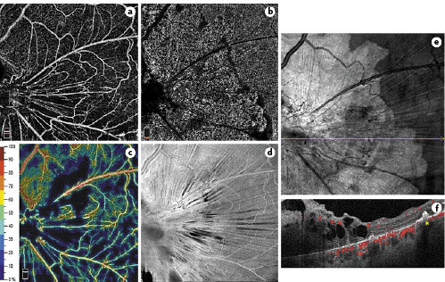 Unilateral Retinal Pigment Epithelium Dysgenesis: Long-Term Natural ...