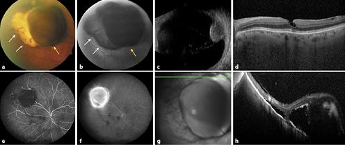 Choroidal Melanoma Simulating Adenoma of the Retinal Pigment Epithelium ...